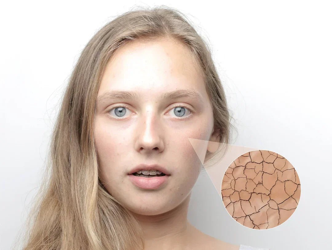 Dry Skin or Dehydrated Skin? Key Differences and Care Tips | The Purest ...